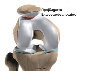 Ασταθεια - Εξαρθρημα Επιγονατιδας | Δρ. Νίκος Παπαλουκάς, Ορθοπαιδικός ...