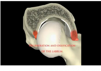 Συνδρομο Μηροκοτυλιαιας Προσκρουσης | Δρ. Νίκος Παπαλουκάς ...